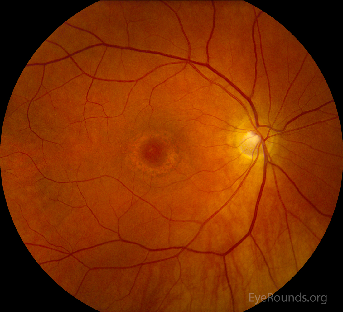 Faktor yang Berhubungan dengan Efek Samping pada Retina Terkait ...