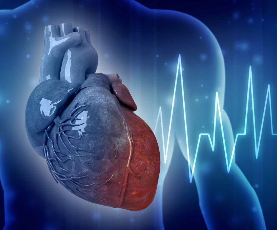 Aritmia pada SLE: Akibat aktivitas penyakit atau pengobatan HCQ ...
